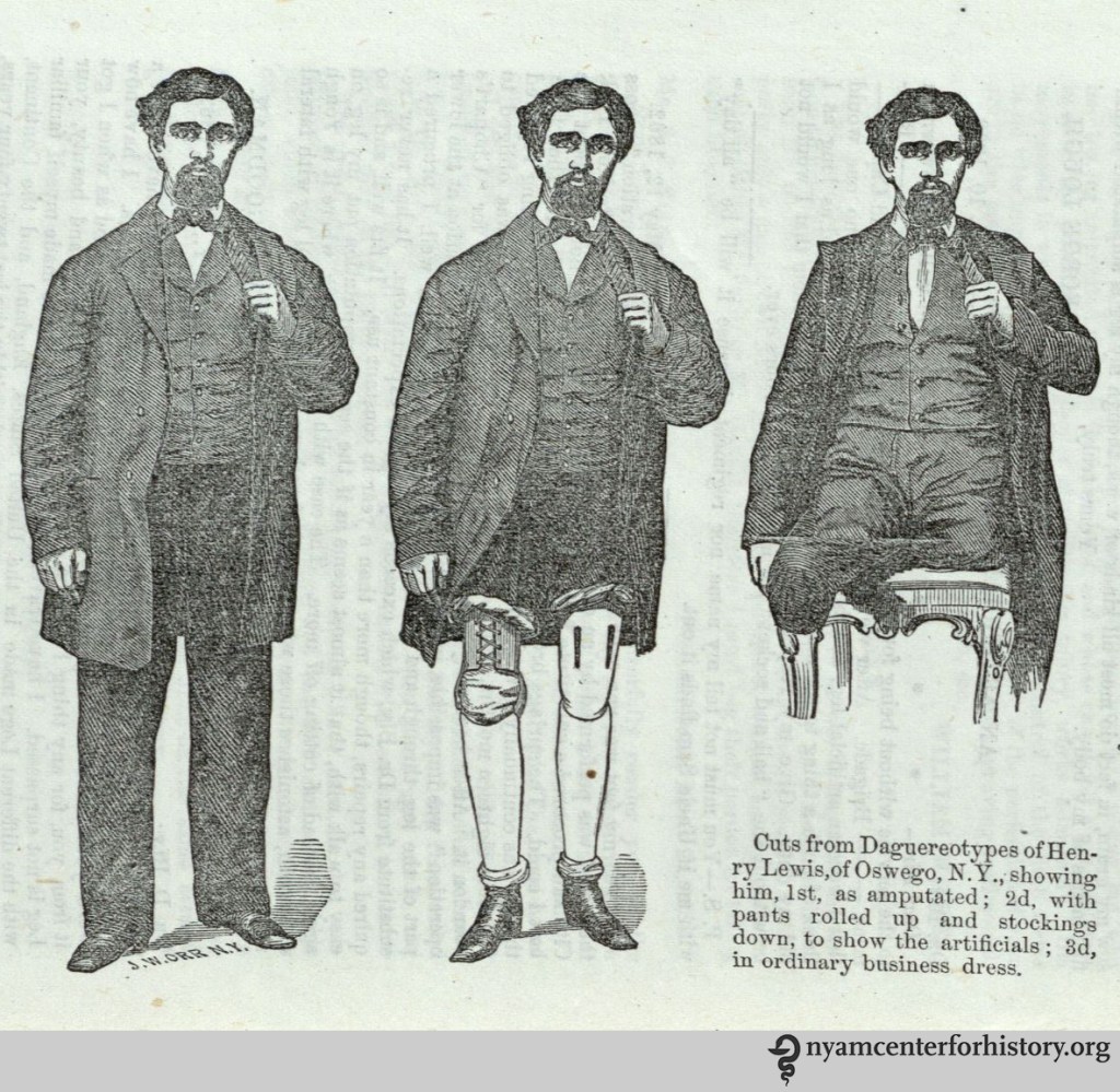 On Paré and Prosthetics | Books, Health and History