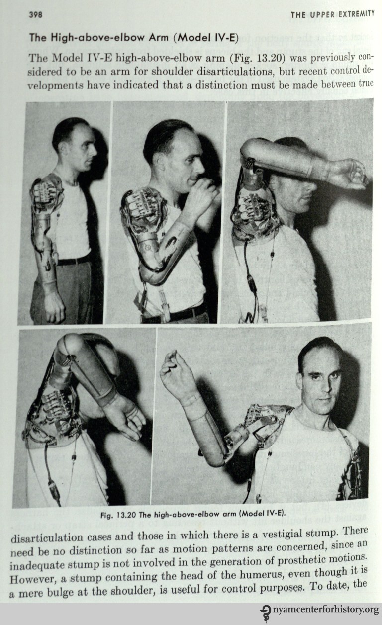 On Paré and Prosthetics | Books, Health and History